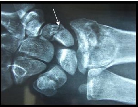 skafoid el bileği kırığı - uludağ sözlük